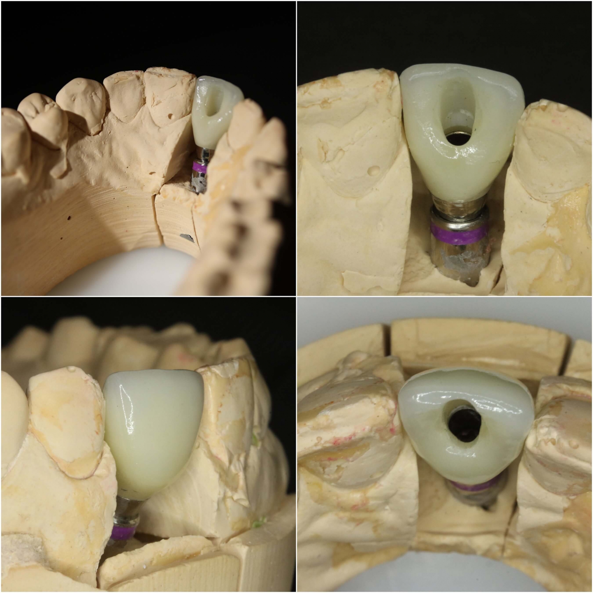Slāņots cirkonija keramikas kronis + zoba implants - Elexdent